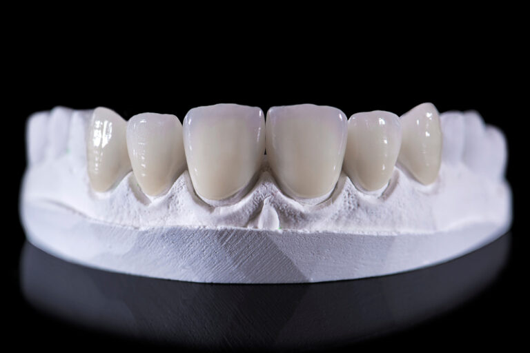 All Ceramic Crowns - Cera-Tech Dental Lab