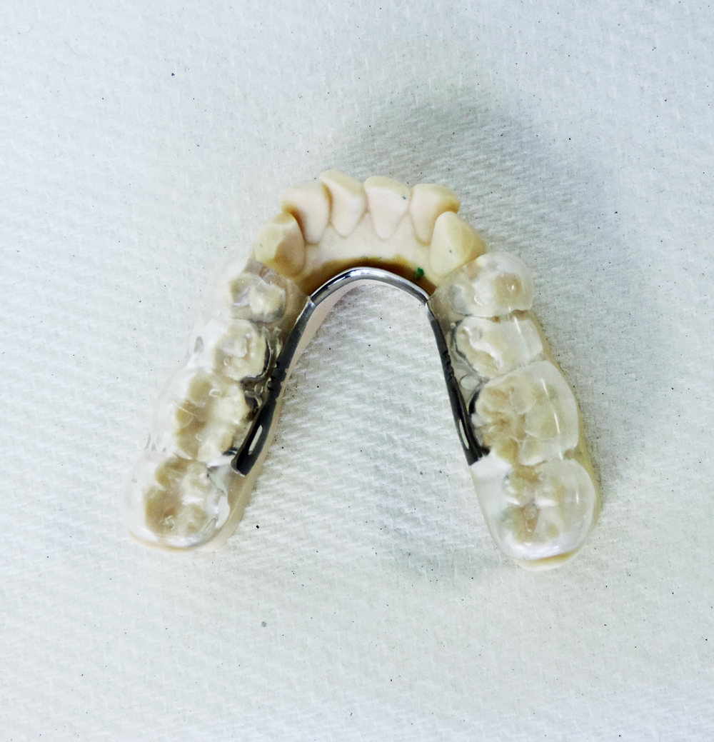 Night Guards and Splint Therapy - Cera-Tech Dental Lab