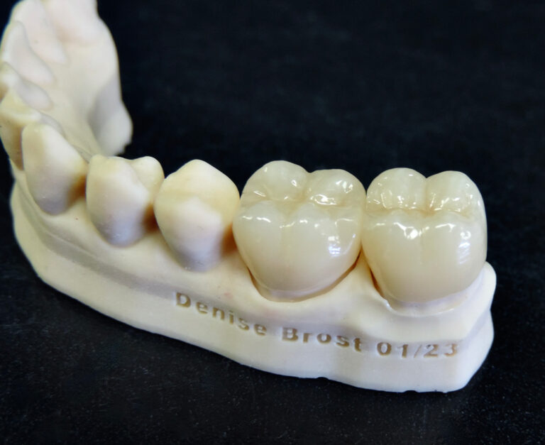 All Ceramic Crowns - Cera-Tech Dental Lab