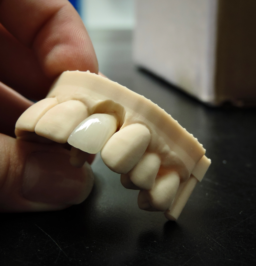 All Ceramic Crowns - Cera-Tech Dental Lab